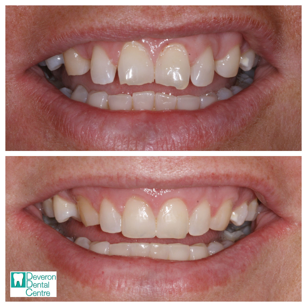 What's Included in Our Invisalign Package - Deveron Dental Centre - Huntly